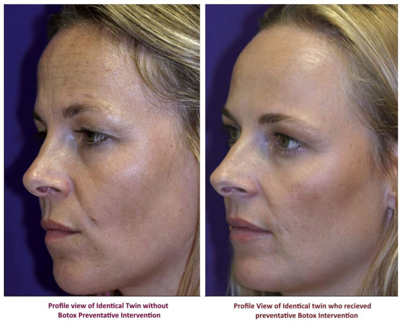 Preventative Botox and the Prejuvenation Beauty Trend: Botox in Your 20 ...